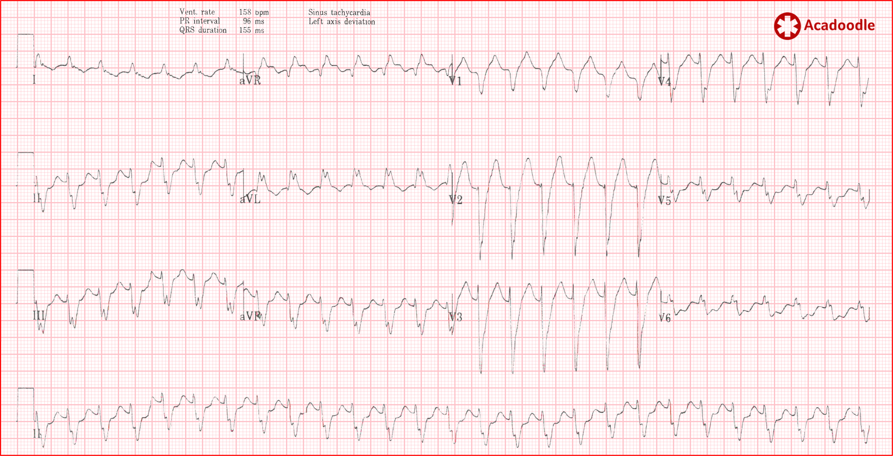 How To Calculate Heart Rate On 12 Lead Ecg Haiper